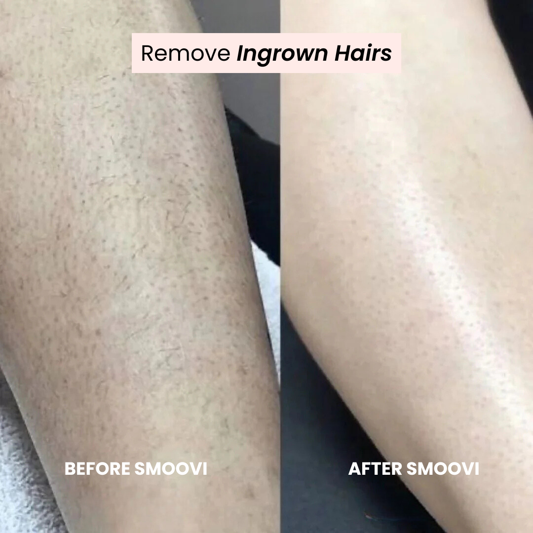 SMOOVI 2.0 Bikini Shaver by PetalSmooth