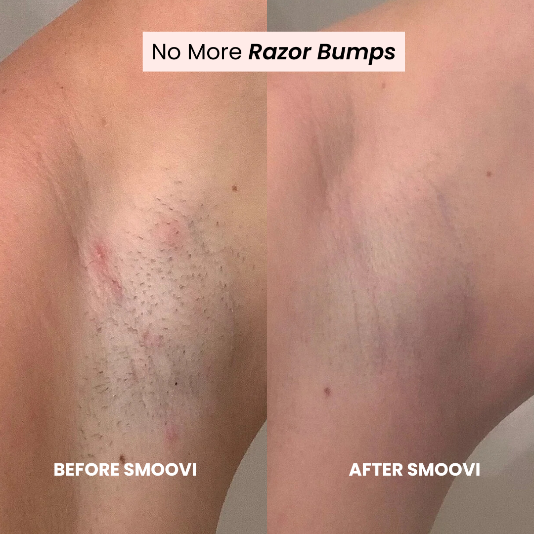 SMOOVI 2.0 Bikini Shaver by PetalSmooth